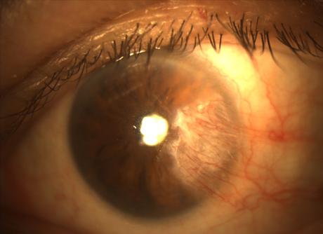 Pathologie de la conjonctive - Docteur Aurélien Hay