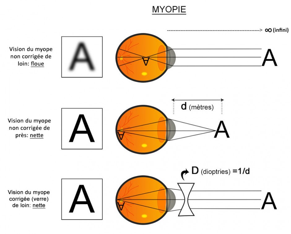 Myopie, presbytie, astigmate, etc - Dr Aurélien Hay